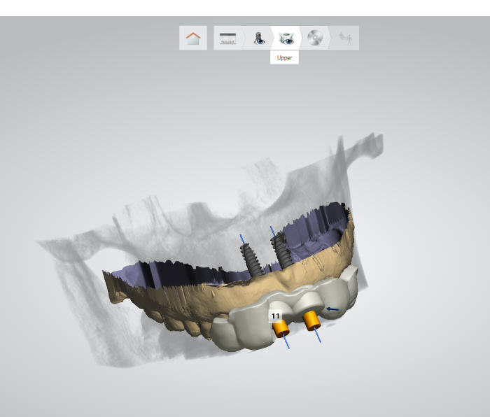 IMPLANTES :: CLINICA DENTAL ESTRADA