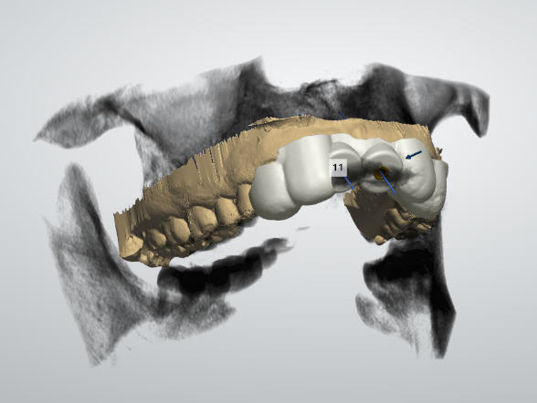 IMPLANTES :: CLINICA DENTAL ESTRADA